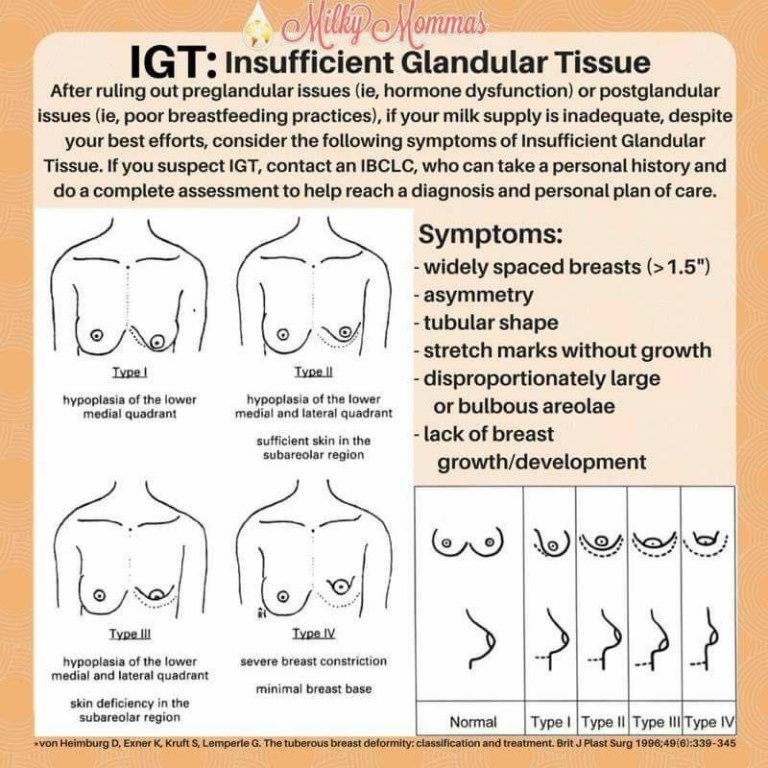Insufficient Glandular Tissue as a cause of low supply – Flow Cranio ...